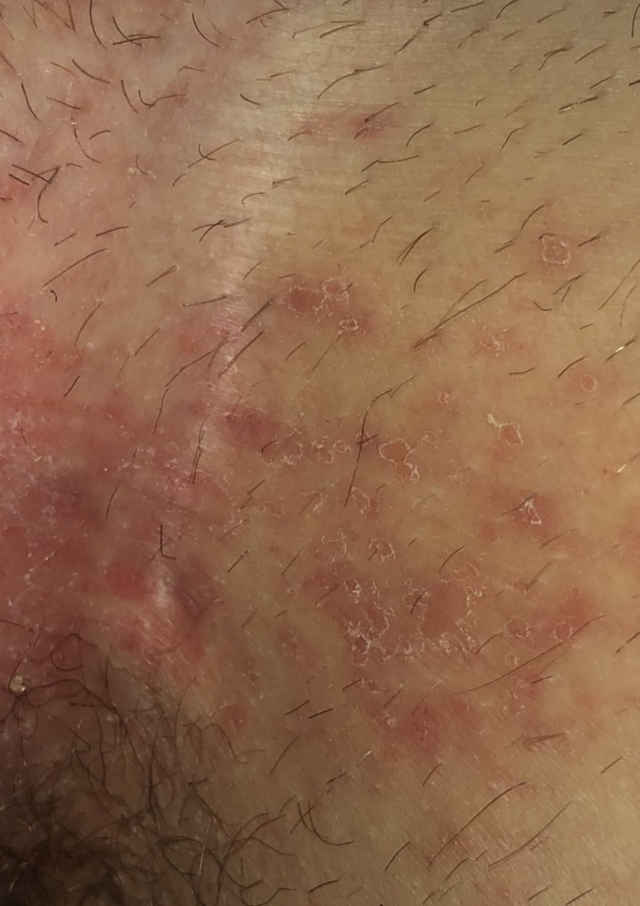 Jock Itch Vs Herpes